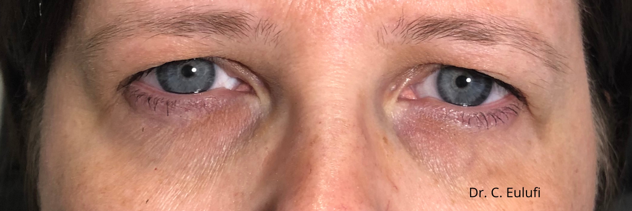 Blepharoplasty and dermatochalasis - Ophthalmic Center