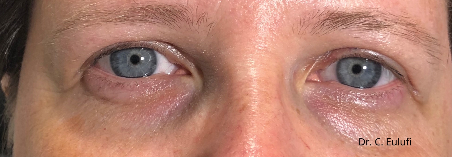 Blepharoplasty and dermatochalasis - Ophthalmic Center