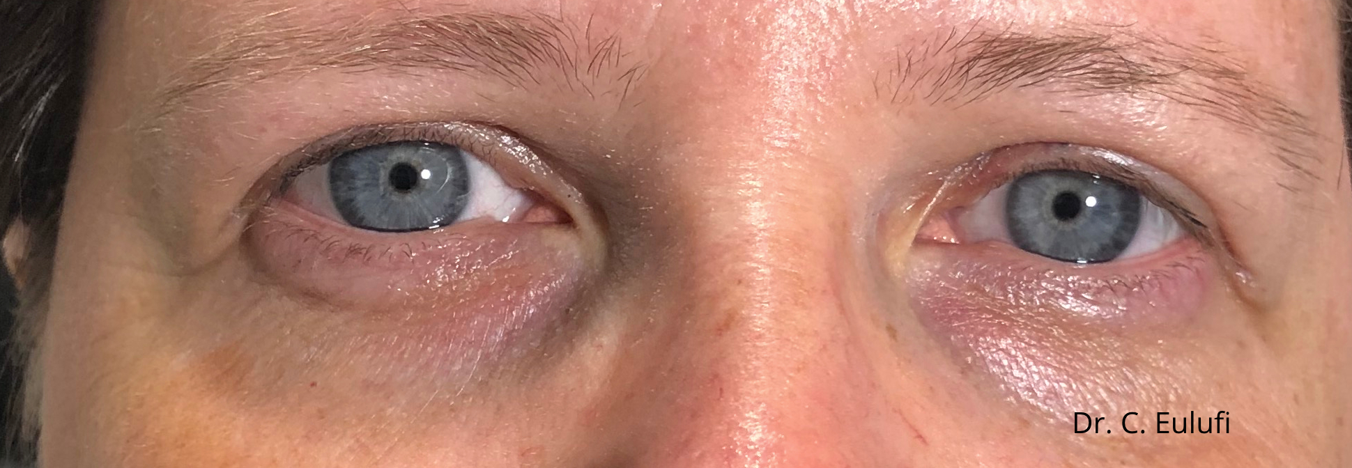 Blepharoplasty and dermatochalasis - Ophthalmic Center