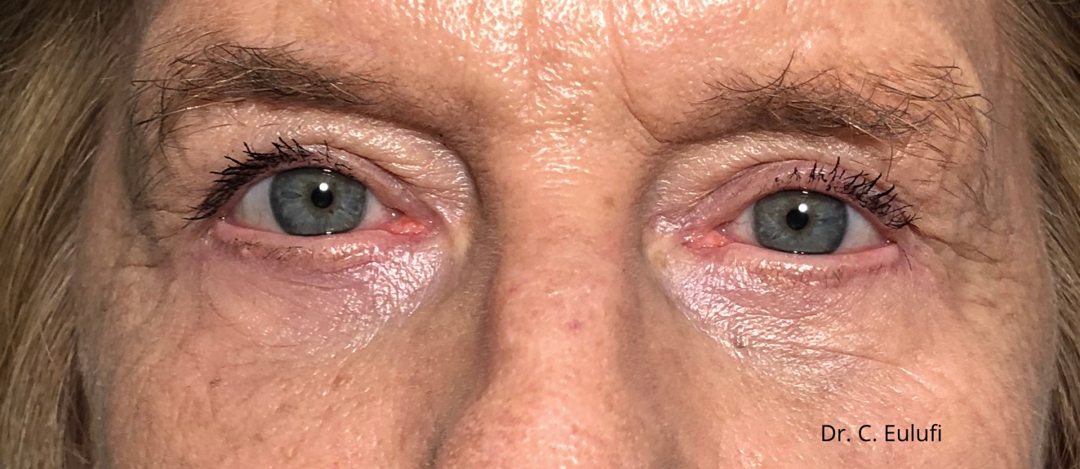 Blepharoplasty and dermatochalasis - Ophthalmic Center