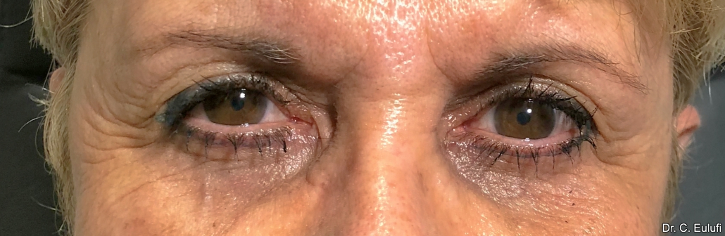 Ptosis der Augenlider - Centre Ophtalmologique Place de Paris Luxembourg