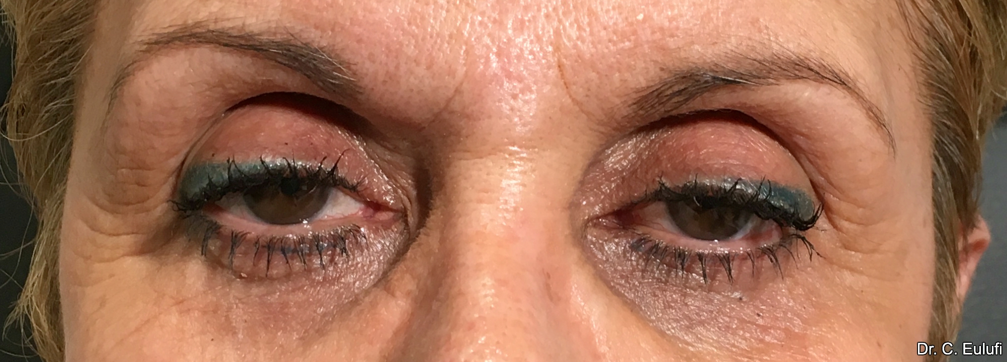 Chirurgie de la ptôse palpébrale au Centre Ophtalmologique