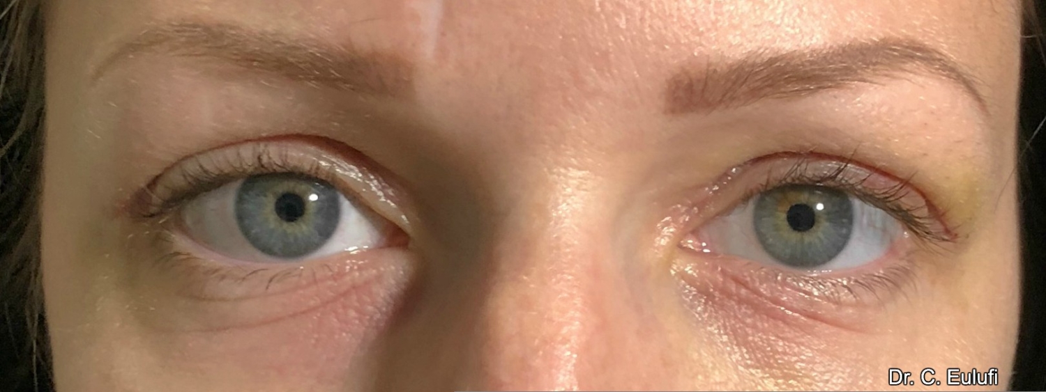 Blepharoplasty and dermatochalasis - Ophthalmic Center