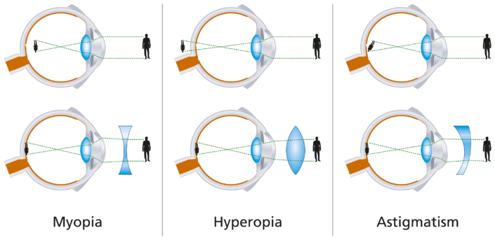 Refraction and its abnormalities - Treatment at the Ophthalmologic Center